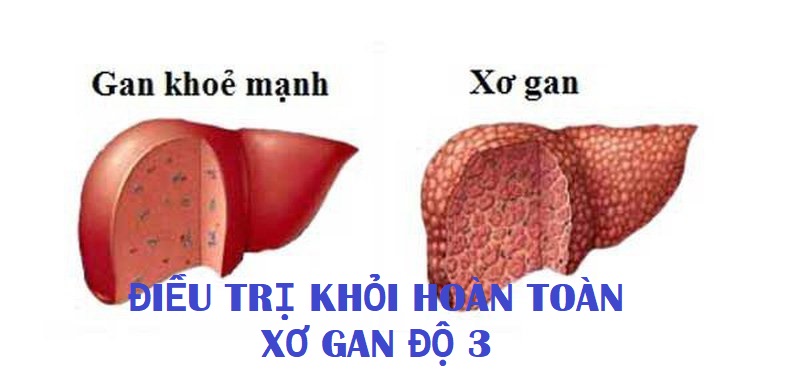 XƠ GAN F3 CÓ CHỮA KHỎI HOÀN TOÀN ĐƯỢC KHÔNG? - GAN A SÚA